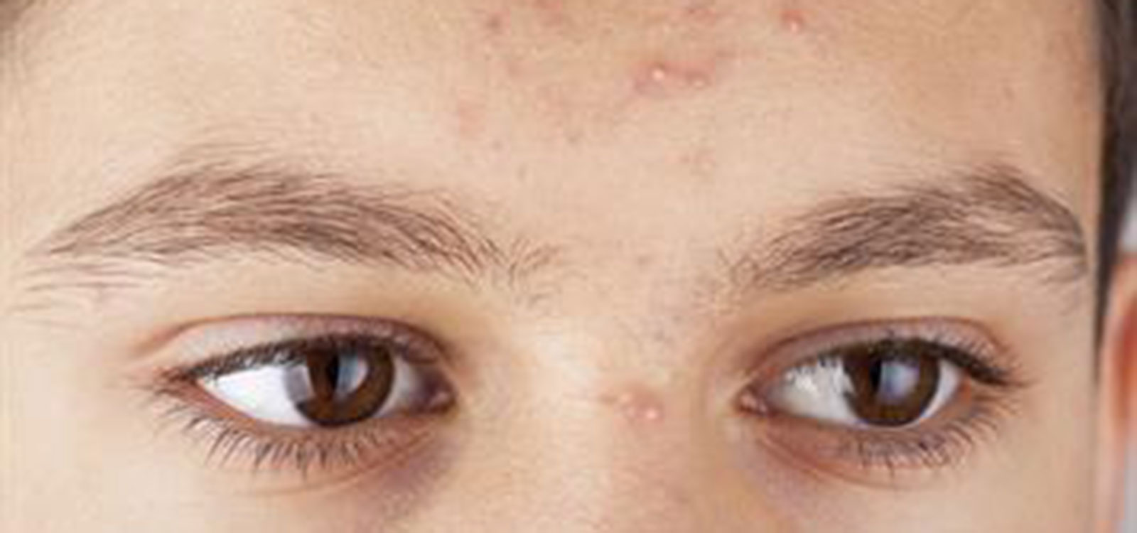 Pediatric Acne - MedScience